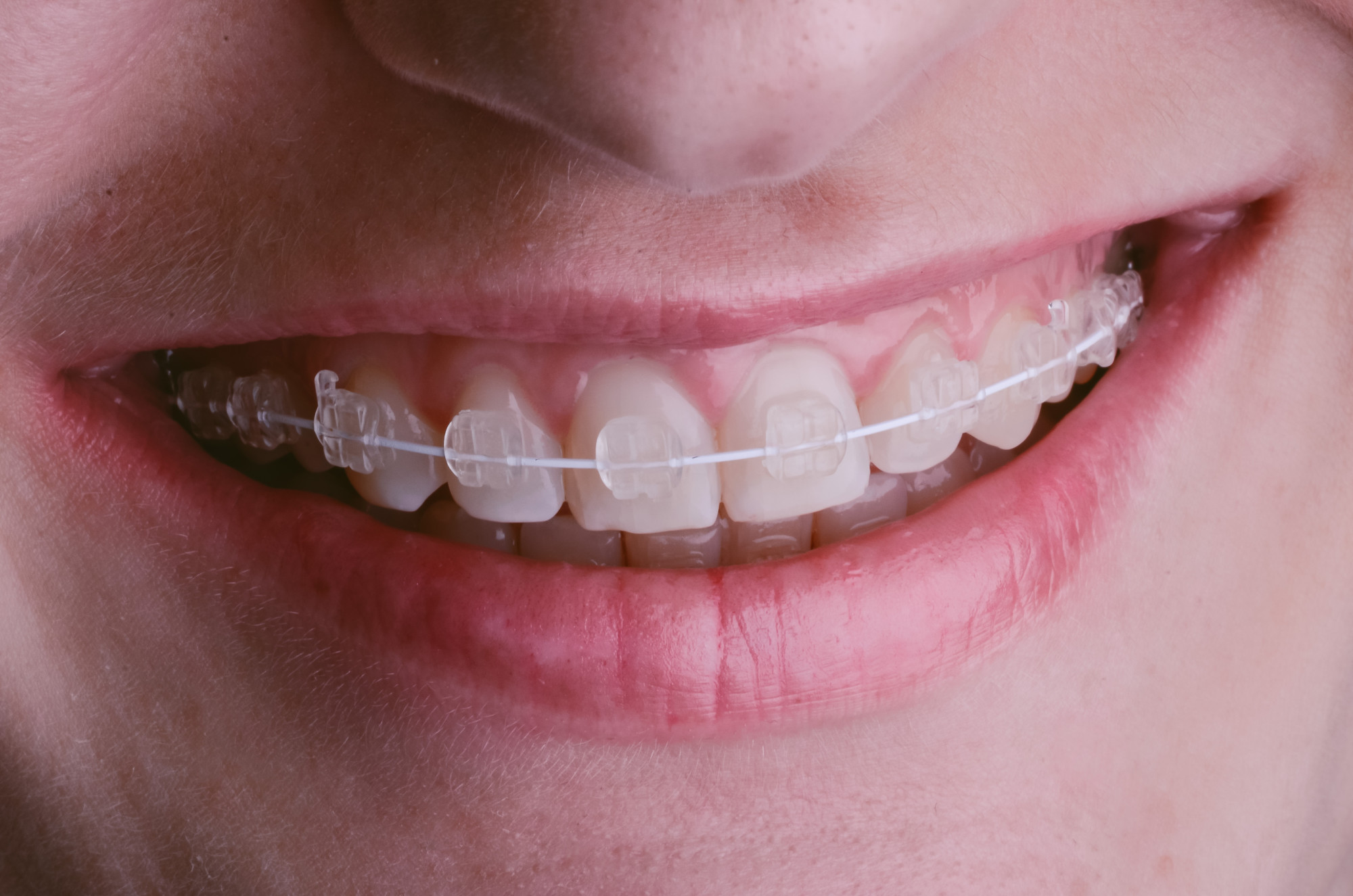 What to Expect During the Process of Getting Braces - Larson Orthodontics